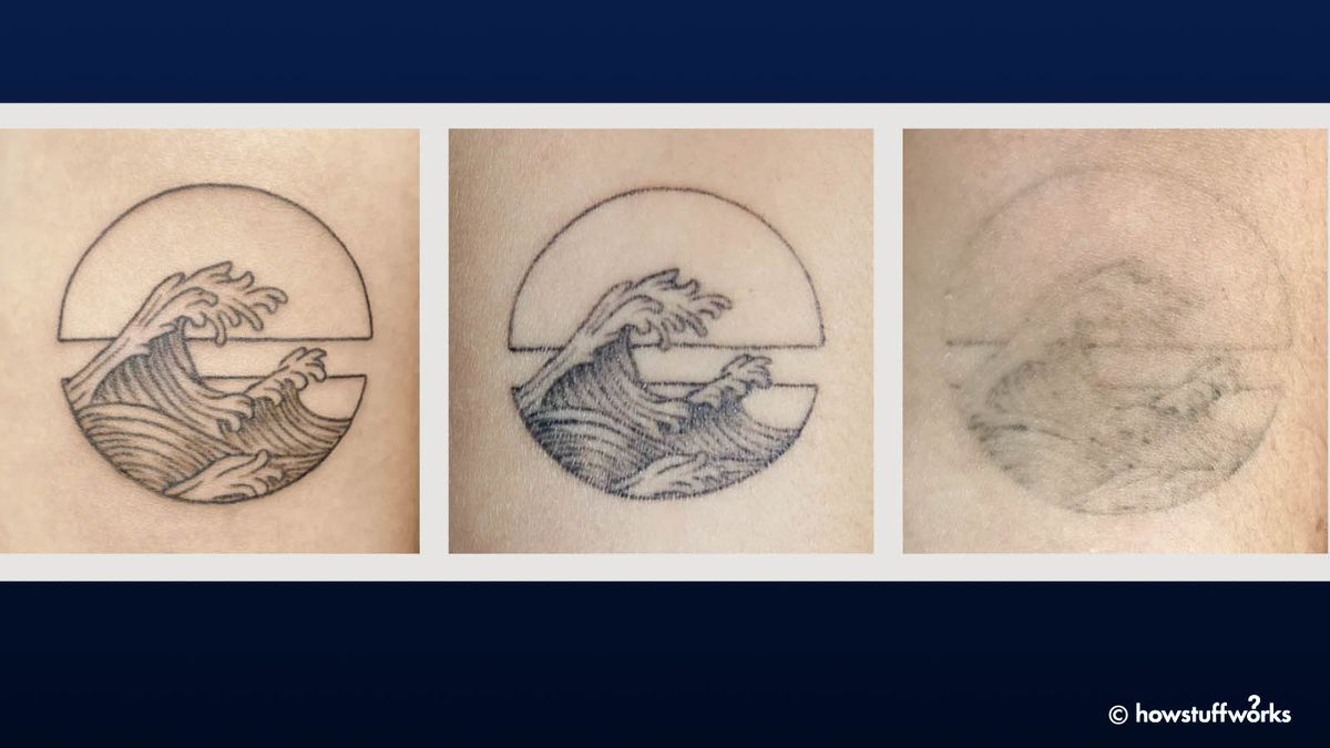 Try a Tattoo Without the Commitment | HowStuffWorks